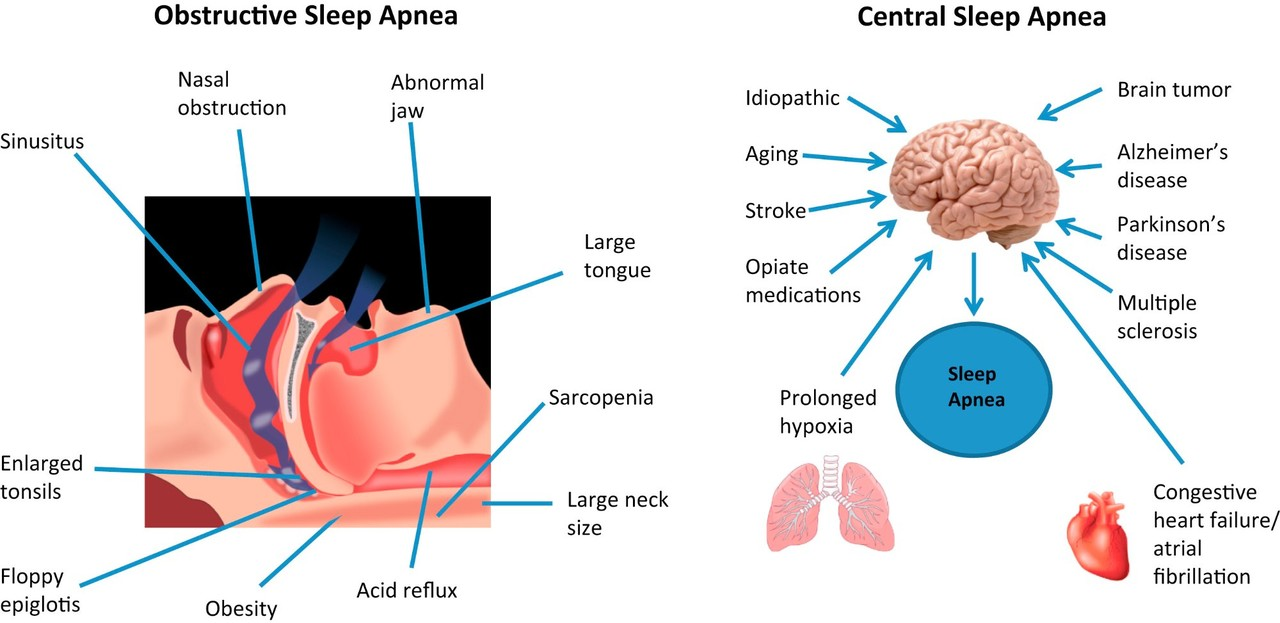 Central Sleep Apnoea Detection vs OSA | Prevalence & Monitoring Software